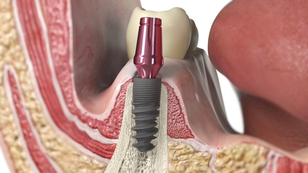 Why Implants - ROOTT