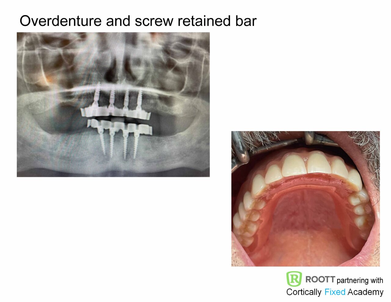 Patient Cases - ROOTT
